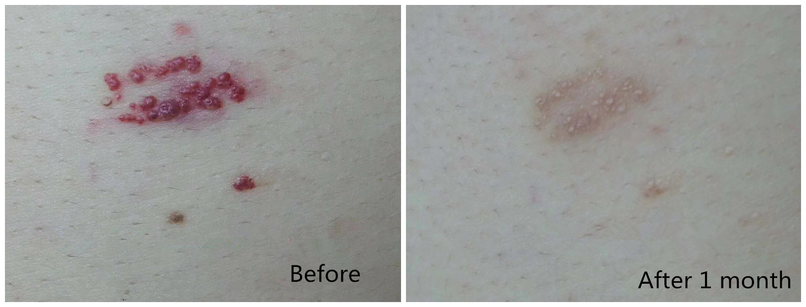 News - Long Pulsed Nd:YAG Laser used for vascular