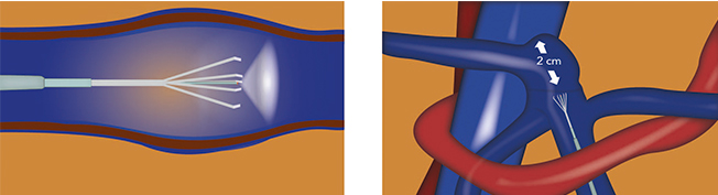 News - Varicose veins and endovascular laser