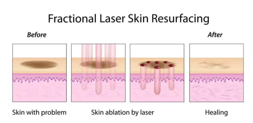 News - Fraxel Laser VS Pixel Laser