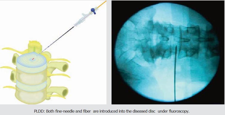 News - How Percutaneous Laser Disc Decompression (PLDD) Works