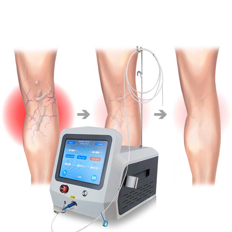China Advanced Diode Lasers for Varicose Veins Treatment – 980nm & 1470nm (EVLT) factory and ...