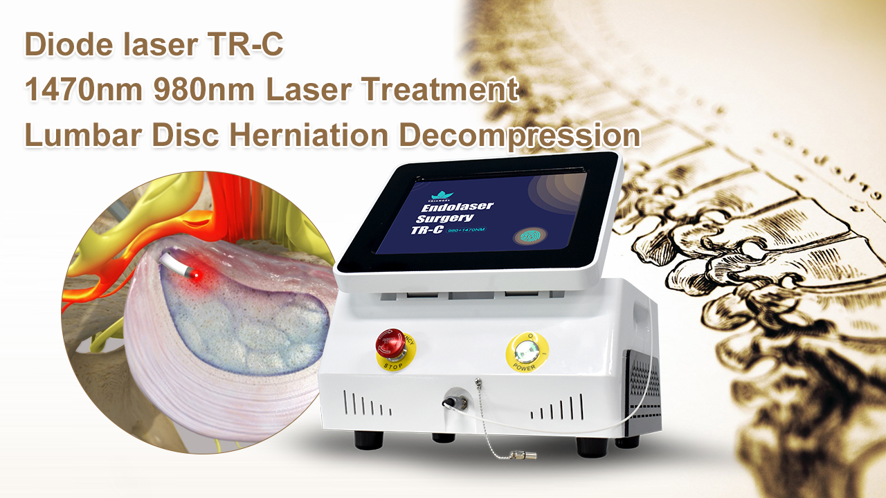 News - How Percutaneous Laser Disc Decompression (PLDD) Works